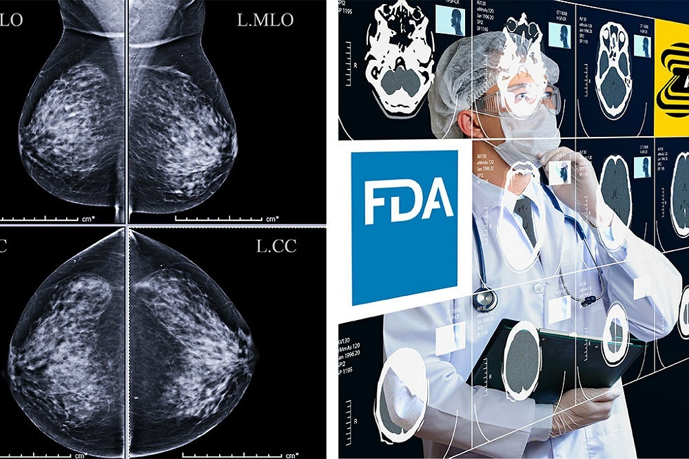 ZEBRA MEDICAL VISION: Secures its First FDA Clearance in Oncology ...