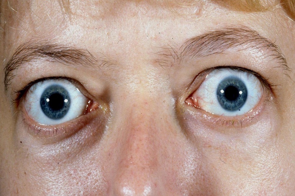 U.S. FDA: FDA approves first treatment for thyroid eye disease - FDA ...